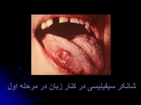 دانلود پاورپوینت بیماری های مقاربتی باران فایل